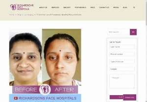 Common Types Of Lip Lift Surgeries Viesearch