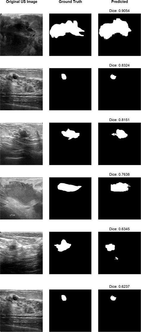 Some Sample Segmentation Of Ultrasound Tumours By Multirusnet