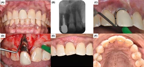 Clinical Photographs From Case A Frontal View Showing Tooth Download Scientific Diagram