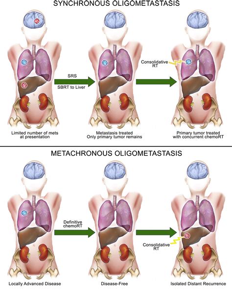 Consolidative Radiotherapy In Oligometastatic Lung Cancer Patient Selection With A Prediction