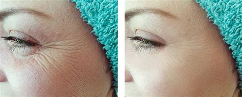 Stunning Hydrafacial Before And After Results Revealed