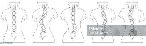 A Simple Illustration Of A Scoliotic Spine Stock Illustration Download Image Now Scoliosis