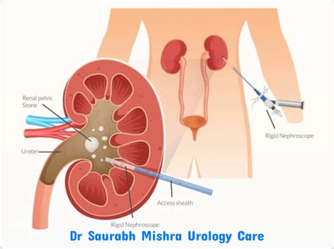 Pcnl Advanced Urology Care