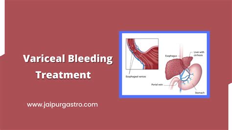 Variceal Bleeding Treatment In Jaipur By Dr Shankar Dhaka Jaipurgastro