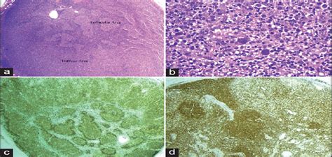 Follicular Lymphoma Evolving Into Diffuse Large B Cell Lymph Indian Journal Of Pathology