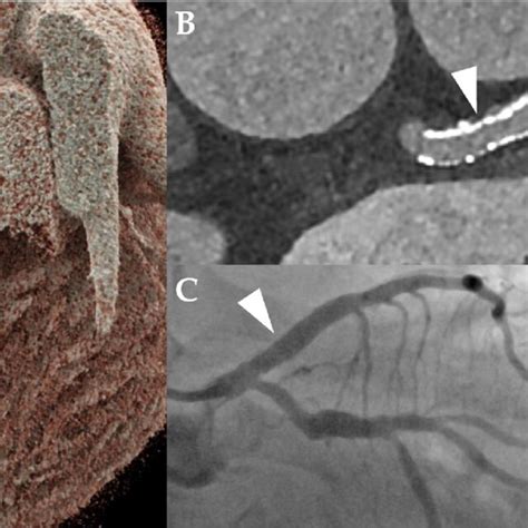 Ultra High Resolution Photon Counting Detector Ct Angiography Pcd Cta