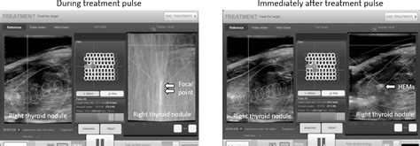 A Propensity Matched Analysis Of Clinical Outcomes Between Open Thyroid