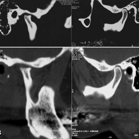 Condylotomy A Schematic Drawing Of The Osteotomy Pre Operative