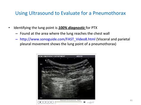 Ultrasonography Fundamentals In Critical Care Lung Ultrasound Pleural