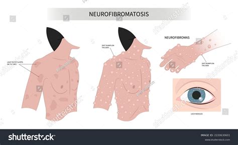 Light Brown Spots On Skin Neurofibroma Stock Vector Royalty Free