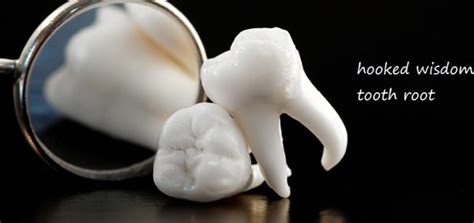 Hooked Wisdom Tooth Root