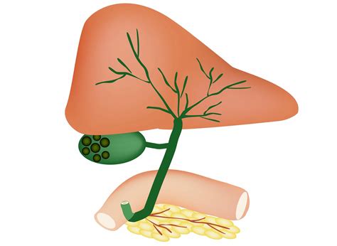 Gallstone Treatment In Ayurveda Ayurvedic Medicine At Karma Ayurveda