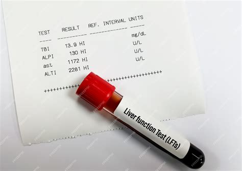 Premium Photo Liver Function Test Including Alt Ast Alp And Total Bilirubin With Abnormal