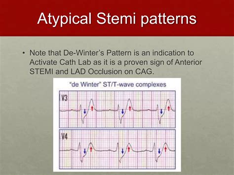 Atypical Stemi Patterns And Stemi Equivalents Pptx Heart And