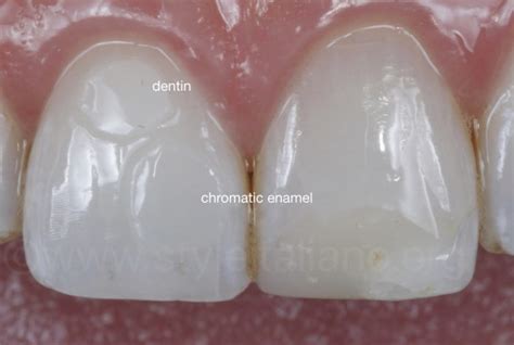 Direct Veneers The Single Incisor Challenge