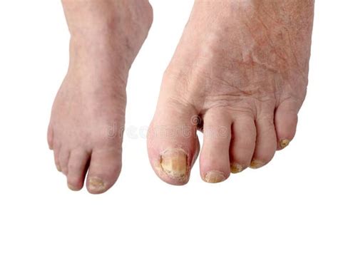 Toenails Affected By Fungal Infection Onycholysis Of Nails Medical