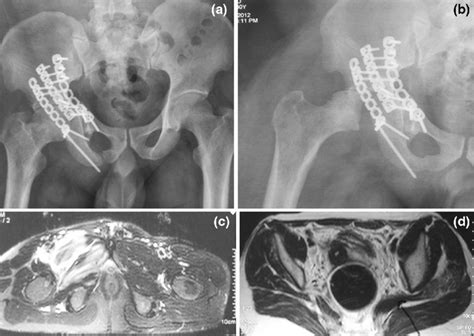 Imaging Of Case 3 Showing T Type Acetabular Fracture A 2 Month Download Scientific Diagram