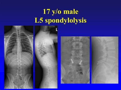 Spondylolysispars Fracture Surgical Treatment Part 6 Growing Spine