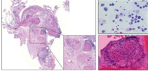 Cytological And Histological Findings In Sarcoidosis A Transbronchial
