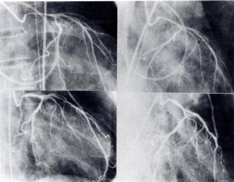 Regression Of The Left Main Trunk Lesion By Steroid Administration In