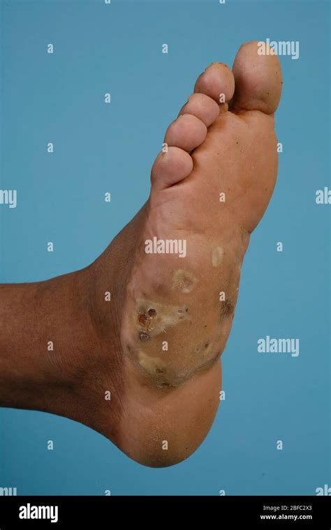 Close Up Of The Foot Of A Mycetoma Sufferer Mycetoma Is An Uncommon