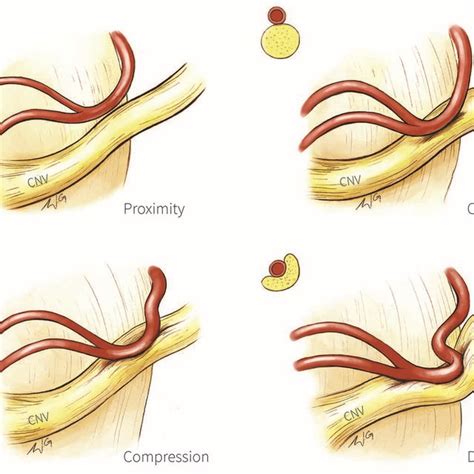 Trigeminal Root Entry Zone REZ Abnormalities In Trigeminal Neuralgia Download Scientific