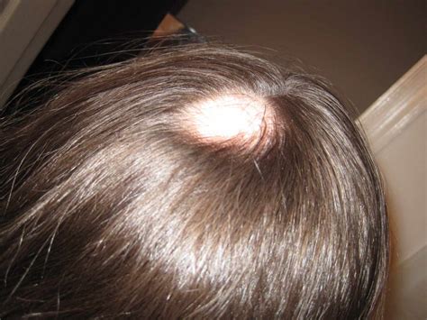 Living With Alopecia Areata Hair Loss