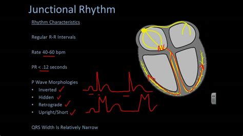 Junctional Rhythm Inverted P Wave