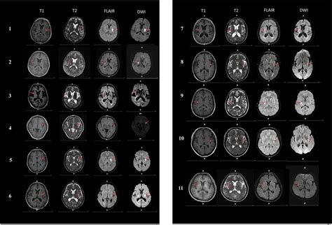 Magnetic Resonance Imaging Mri Was Performed On 11 Smokers With