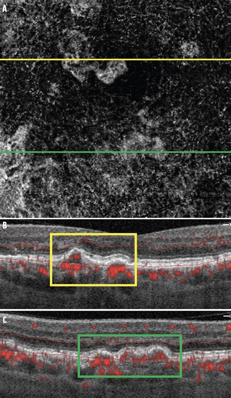 A Reference Guide For Oct Angiography Retina Today