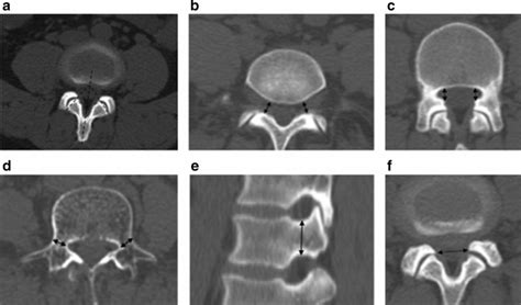 Measurement Illustration For Osseous Structure Parameters Of The Download Scientific Diagram