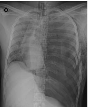 Trauma Flashcards Quizlet