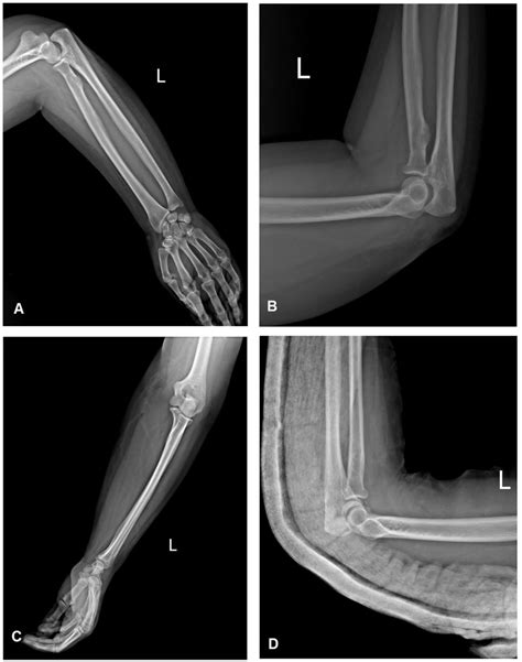 Radiographs Of The Elbow Joint For Diagnosis Of Dislocation A And B Download Scientific