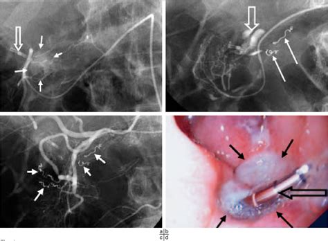Chronic Enteritis Ulcerative Colitis Semantic Scholar