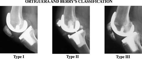 Ortiguera And Berrys Classification Download Scientific Diagram