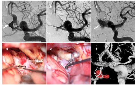 A 55 Year Old Patient With Recurrent Acom Aneurysm Initial Angiogram