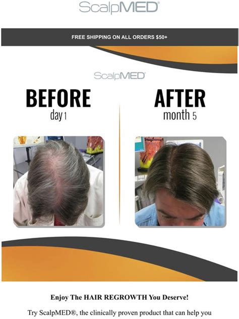 Scalpmed Enjoy The Hair Regrowth You Deserve Milled