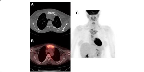 A Computed Tomography Ct Scan Of The Thorax Demonstrating Sclerosis