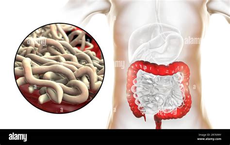 Round Worms In Human Large Intestine Computer Artwork Roundworms Or Nematodes Include