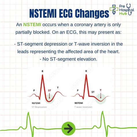 Pre Do You Know The Difference Between A Stemi And Nstemi