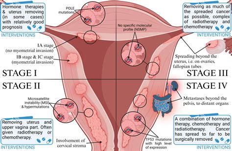 Endometrial Cancer New Findings On Endometrial Cancer Treated With