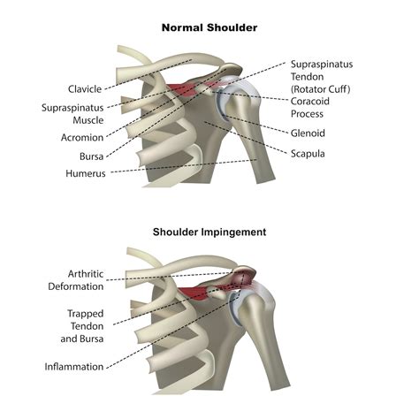 Can Cycling Cause Shoulder Impingement