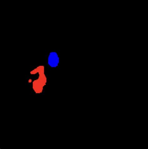 Radiology Ml Multi Image Segmentation With Transunet