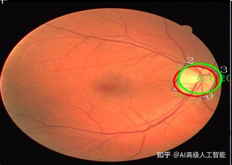 基于机器视觉的视网膜血管和黄斑分割识别 知乎