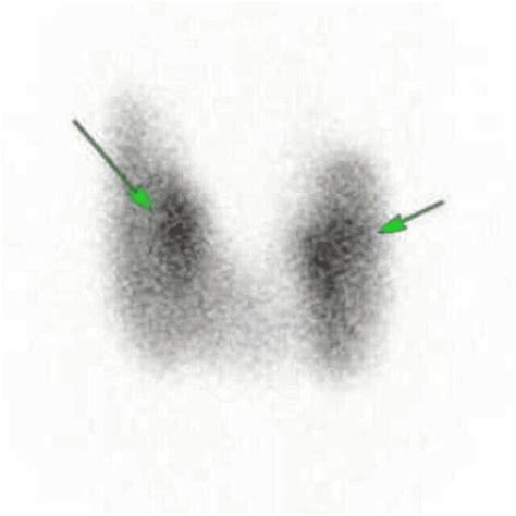 Radioactive Iodine Uptake Raiu Test Shows Large Right And Left Download Scientific Diagram