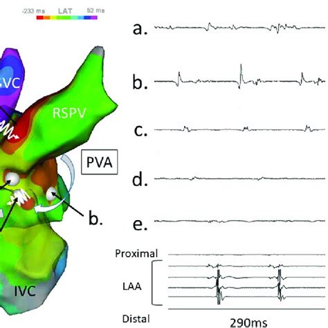 Biatrial Activation Map From Posterior Cranial View And Local