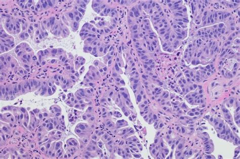 Jama Surgery On Linkedin In This Randomized Clinical Trial Intrathoracic Anastomosis Resulted In…