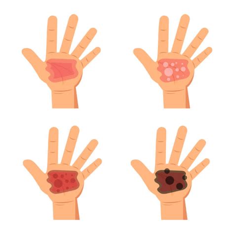 12 300 Chemical Burn Illustrations Royalty Free Vector Graphics