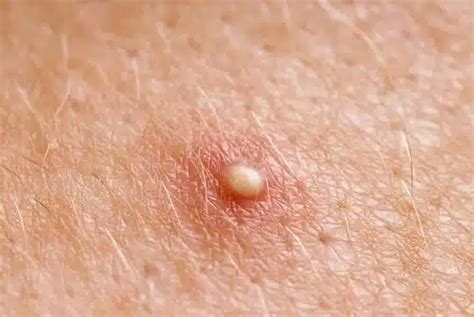 ¿tienes Una “bolita De Grasa” Te Decimos Qué Son Los Lipomas