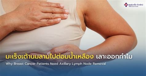 มะเร็งเต้านมลามไปต่อมน้ำเหลือง เลาะออกทำไม ศูนย์ชีวารักษ์